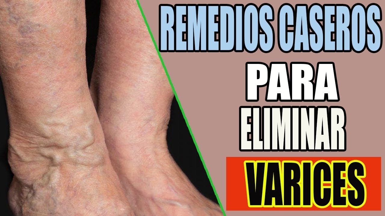 COMO ELIMINAR LAS VARICES DE FORMA NATURAL.. – SaludMaxTop